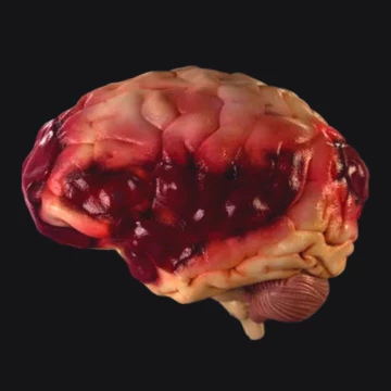 $5M Settlement: 3D Animated TBI Timeline Charts Progression of ...