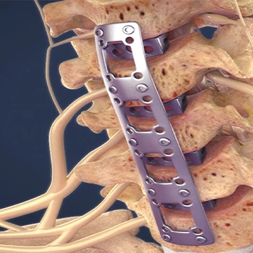 $3.9M Verdict On $0 Offer: Medical Animations Show Extent of Neck ...
