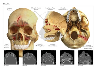 Summary of Soft Tissue Injuries & Skull | High Impact