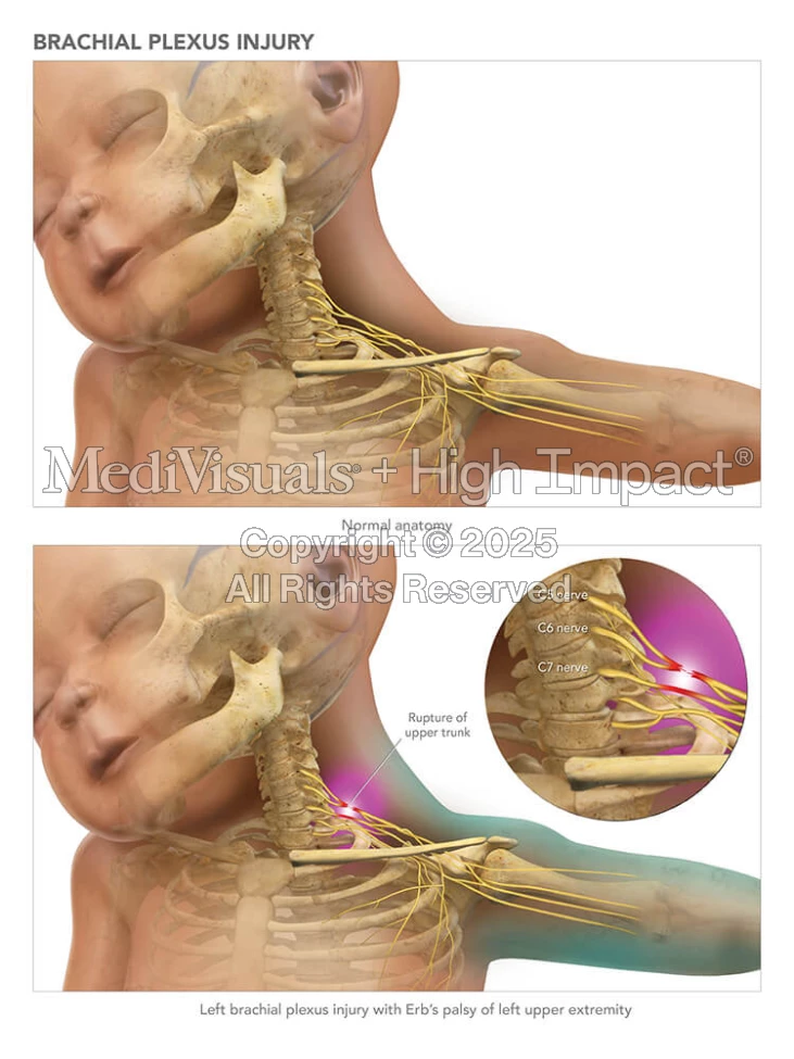 Brachial Plexus Injury | MediVisuals + High Impact