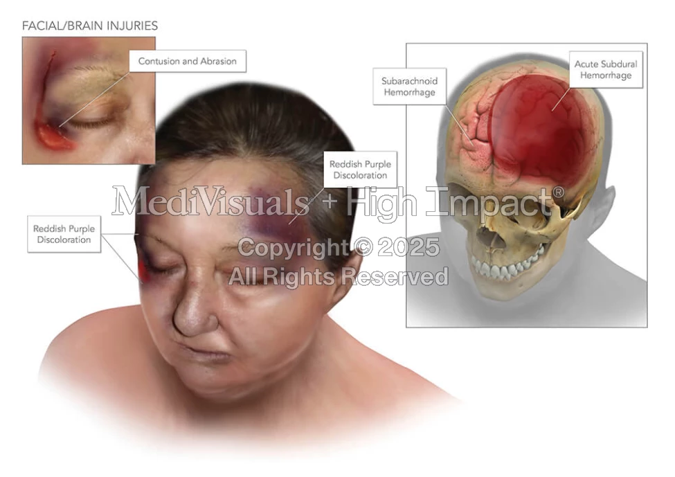 Facial/Brain Injuries | MediVisuals + High Impact