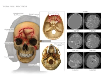 Complex Facial Fractures | MediVisuals + High Impact