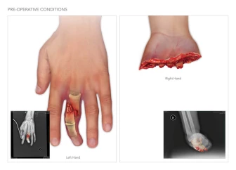 Right Hand Injuries | MediVisuals + High Impact