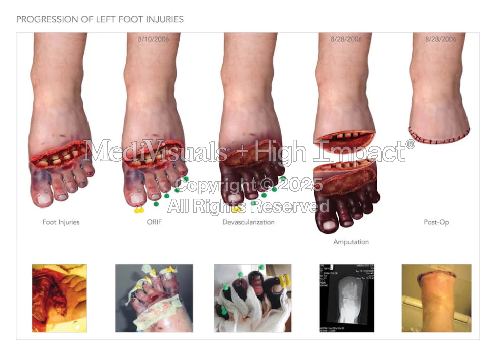 Progression of Foot Injuries | MediVisuals + High Impact