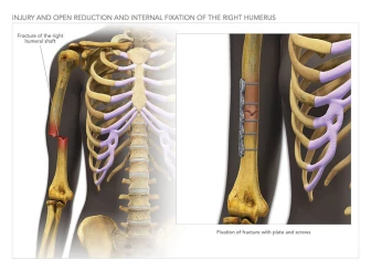 ORIF of Proximal Humerus Fracture | MediVisuals + High Impact