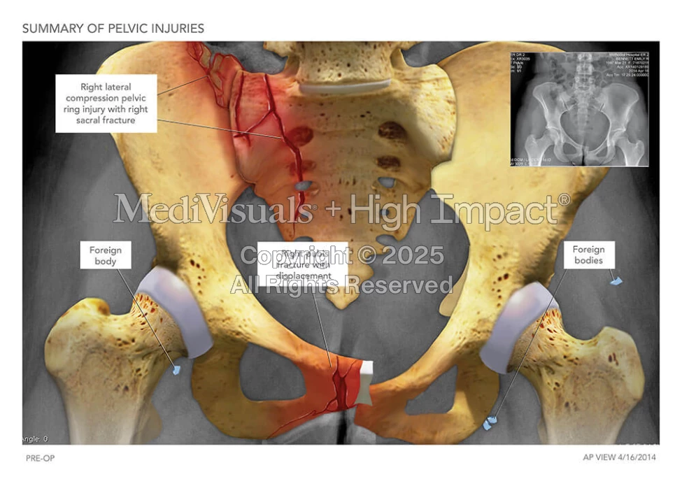 Pelvic Injuries & Repair | MediVisuals + High Impact