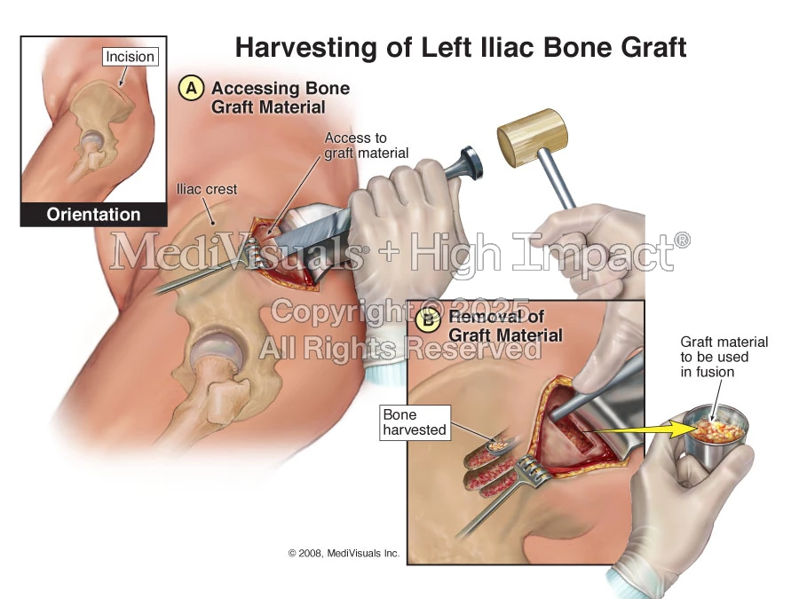 Harvesting of Left Iliac Bone Graft | MediVisuals + High Impact