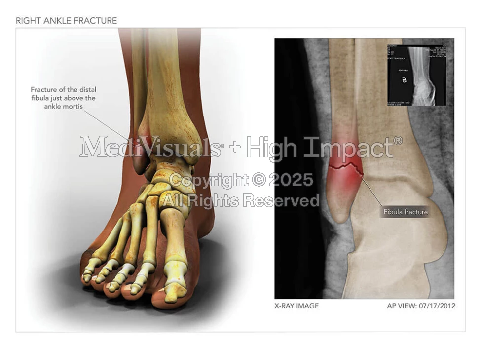 Ankle Fracture - Demonstrative Exhibits