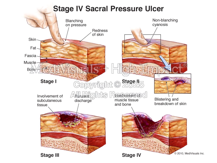 Stage IV Sacral Pressure Ulcer