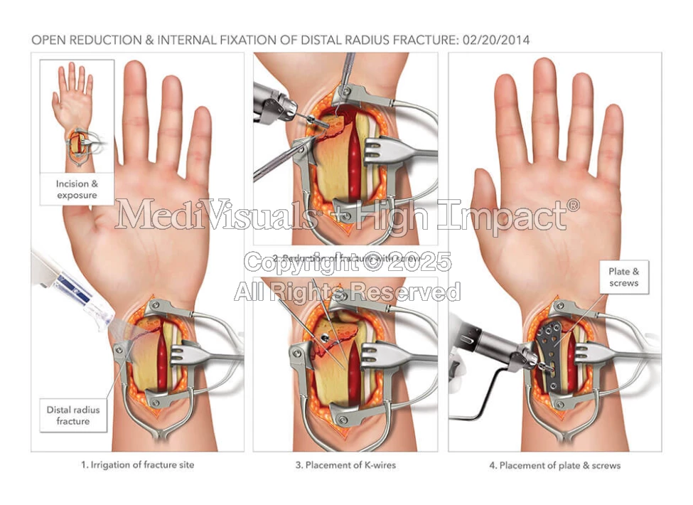 Trial Graphic Orif Medivisuals High Impact