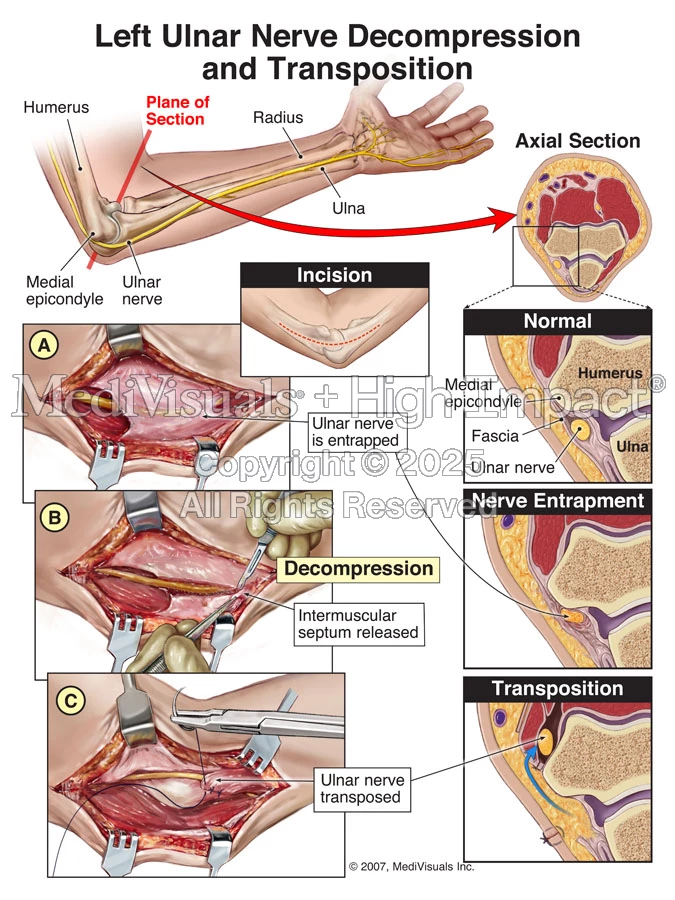 Left Ulnar Nerve Decompression | High Impact