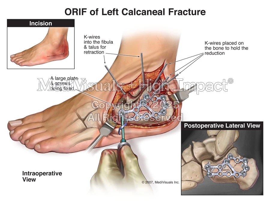 ORIF of Left Calcaneal Fracture | MediVisuals + High Impact