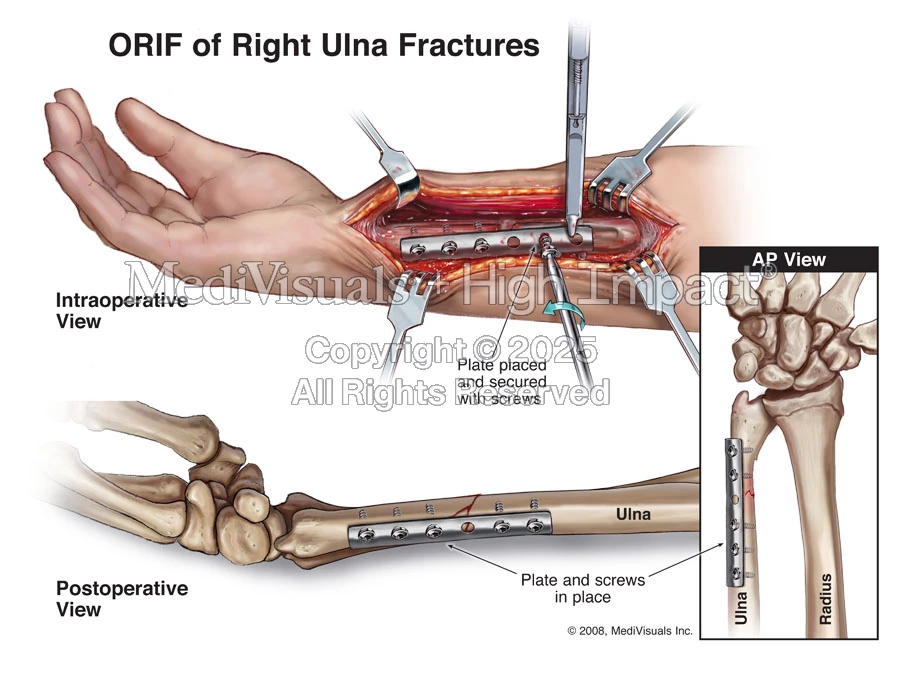 ORIF of Right Ulna Fractures | MediVisuals + High Impact