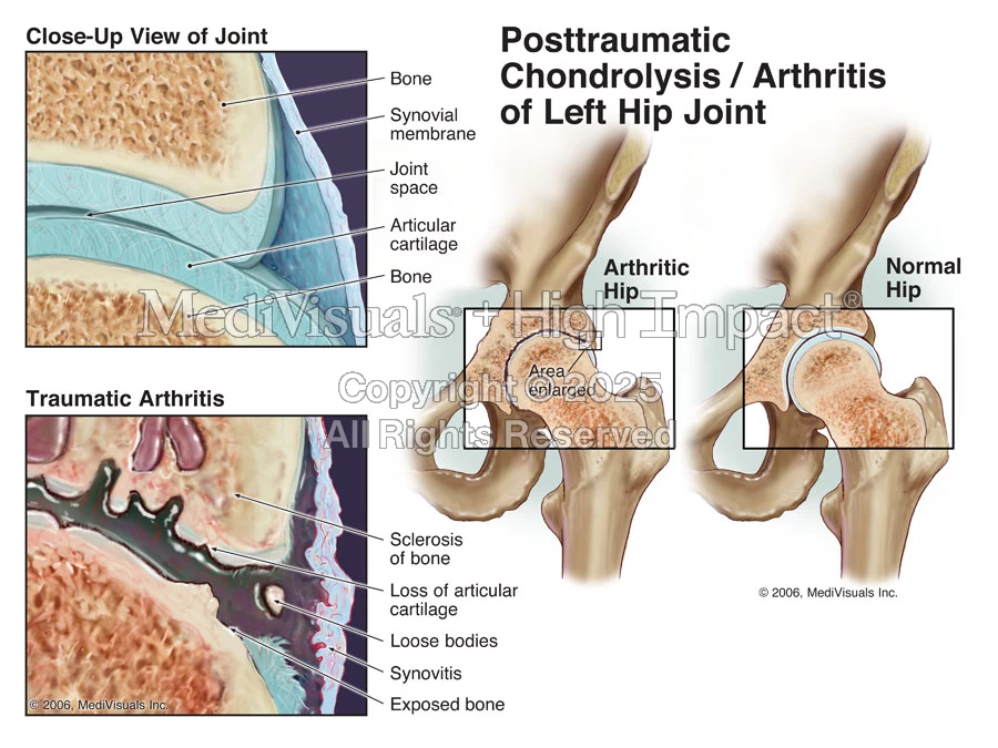 Posttraumatic Chondrolysis / Arthritis of Left Hip Joint | MediVisuals ...