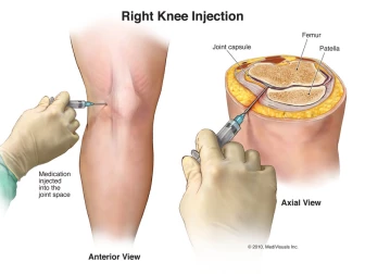 Sacroiliac Injection (SI Joint) | MediVisuals + High Impact