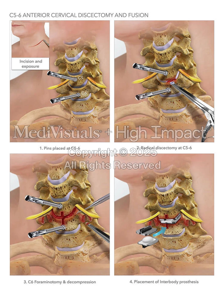 C5-6 Anterior Cervical Discectomy | MediVisuals + High Impact
