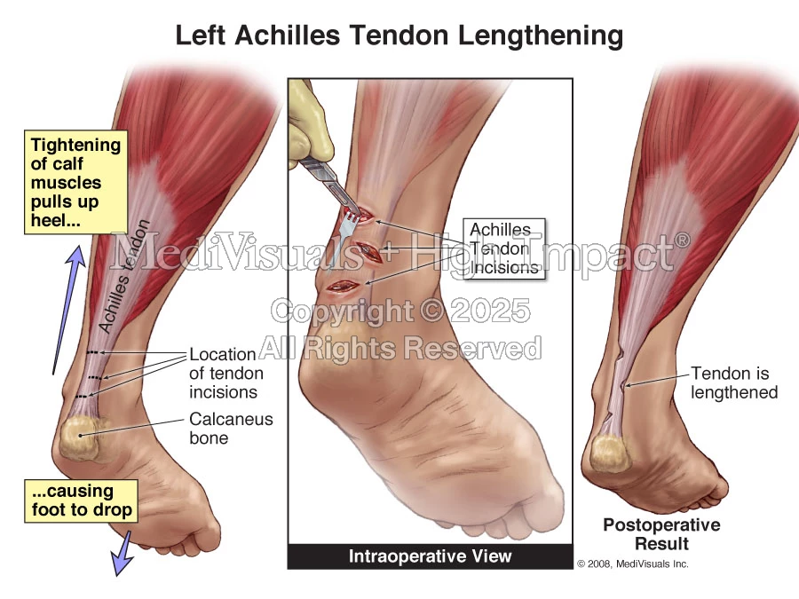Left Achilles Tendon Lengthening | MediVisuals + High Impact