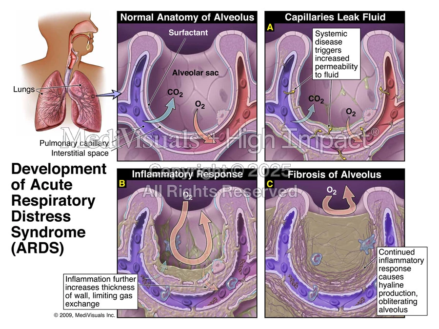 Development of Acute Respiratory Distress Syndrome (ARDS) | MediVisuals ...