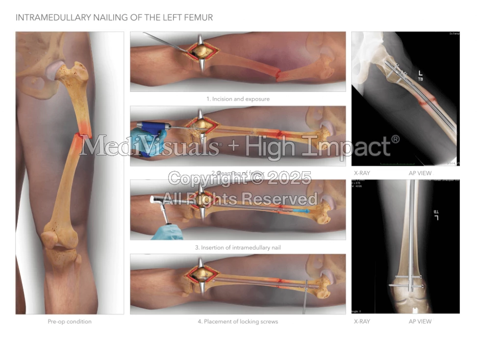 Intramedullary Nailing of Femur | MediVisuals + High Impact