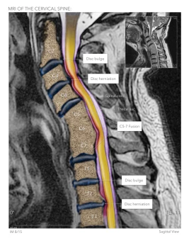 Trial Graphic of Spine Herniations | MediVisuals + High Impact