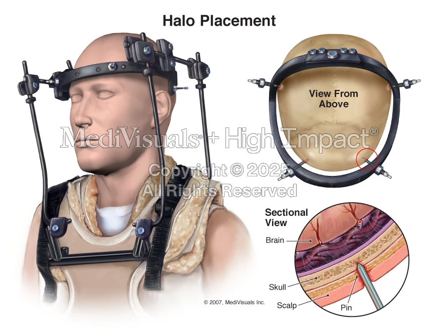 Halo Placement