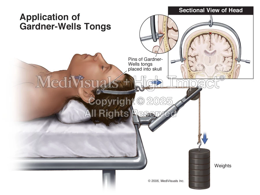 Application of Gardner-Wells Tongs | MediVisuals + High Impact