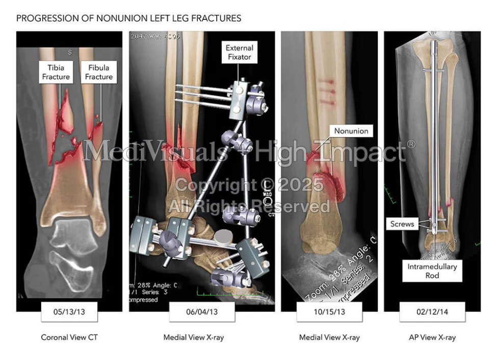 Failed Fixation of Fractures