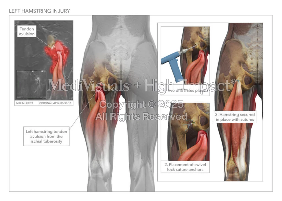 Hamstring Tendon Avulsion | MediVisuals + High Impact