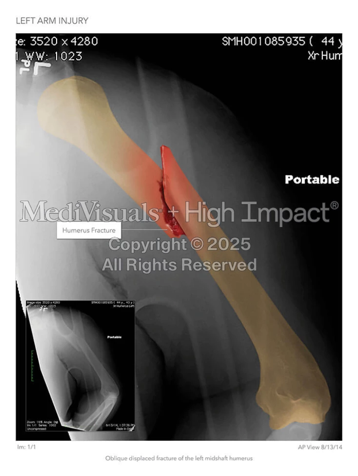 Left Arm Injury | MediVisuals + High Impact