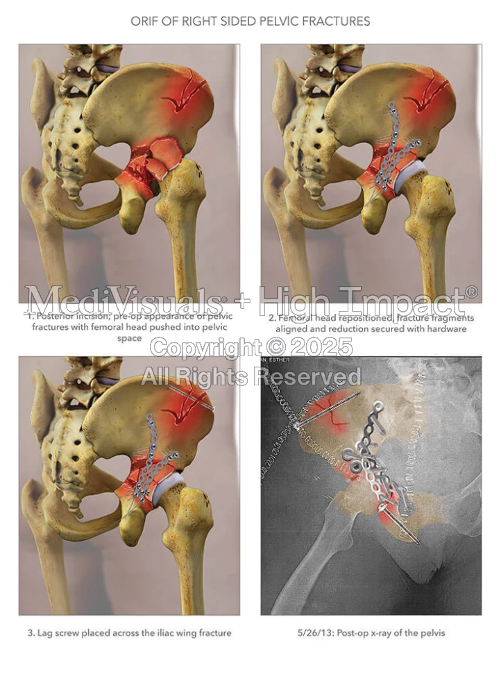 ORIF of Right Sided Pelvic Fractures | MediVisuals + High Impact