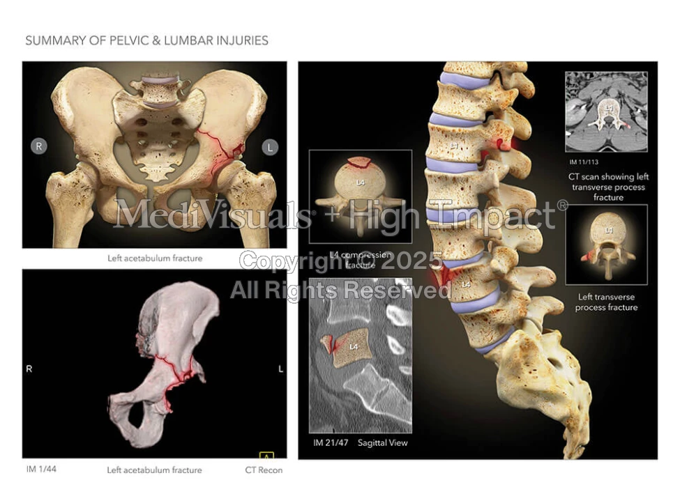 Summary of Pelvic & Lumbar Injuries | MediVisuals + High Impact