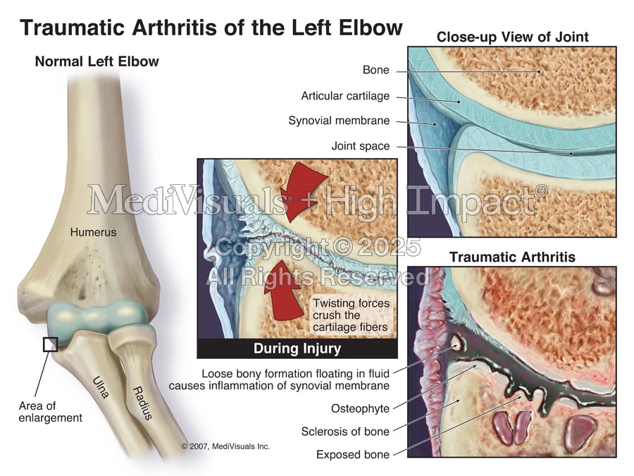 Traumatic Arthritis of the Left Elbow | MediVisuals + High Impact