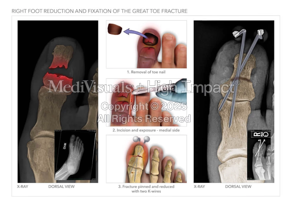 Right Foot Reduction and Fixation of the Great Toe Fracture ...