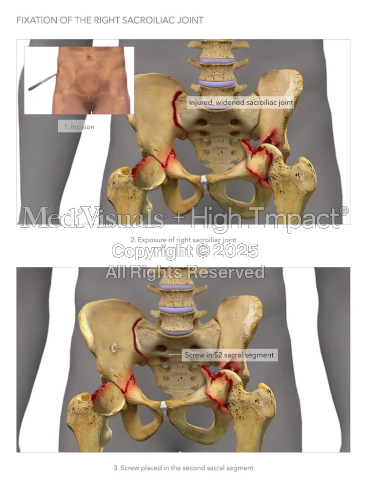 Fixation of the Right Sacroiliac Joint | MediVisuals + High Impact