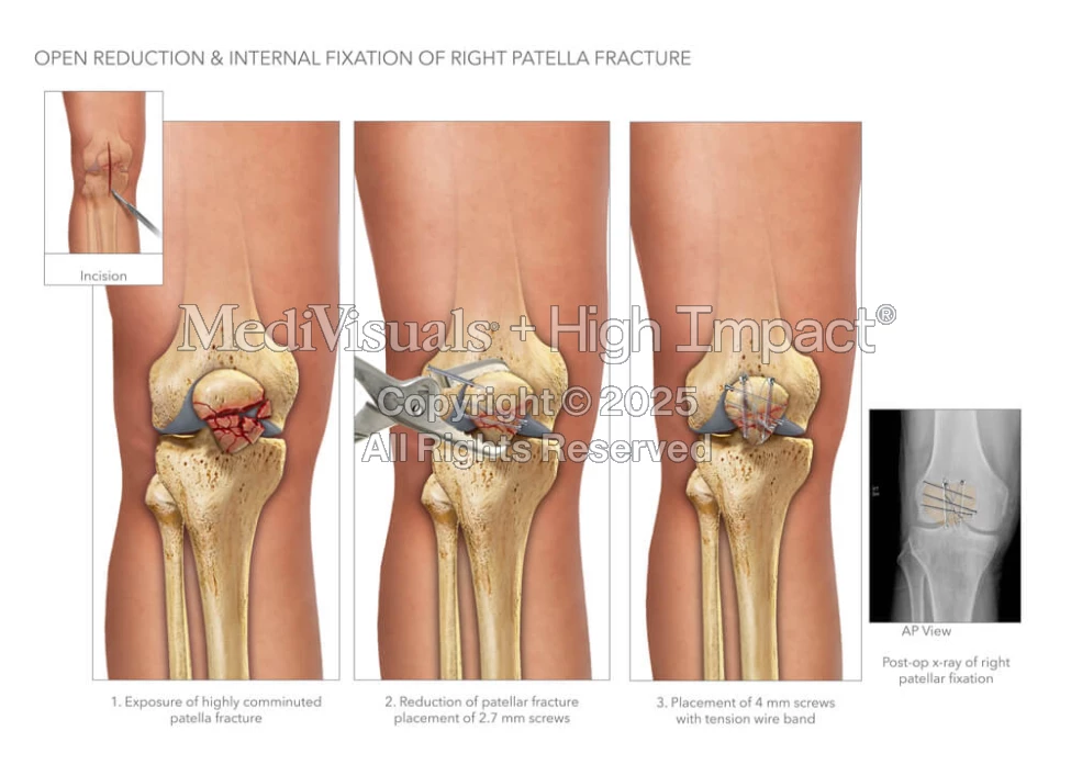 Open Reduction & Internal Fixation of Right Patella Fracture ...