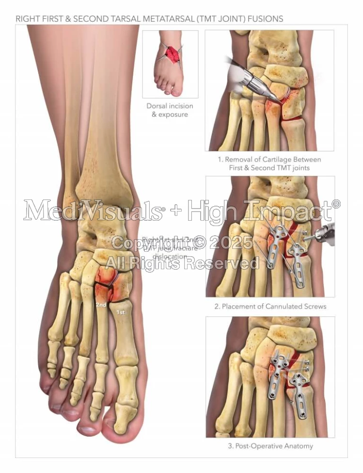 Right First & Second Tarsal Metatarsal (TMT Joint) Fusions ...