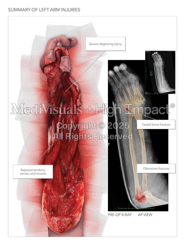 Summary of Left Arm Injuries | MediVisuals + High Impact