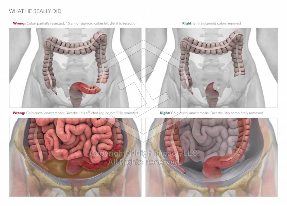 Surgical Error Exhibits | MediVisuals + High Impact