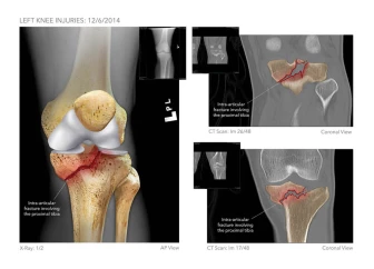 Fractured Femur | MediVisuals + High Impact