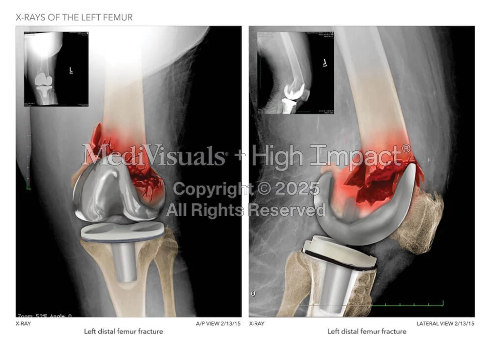 Distal Femur Fracture | MediVisuals + High Impact