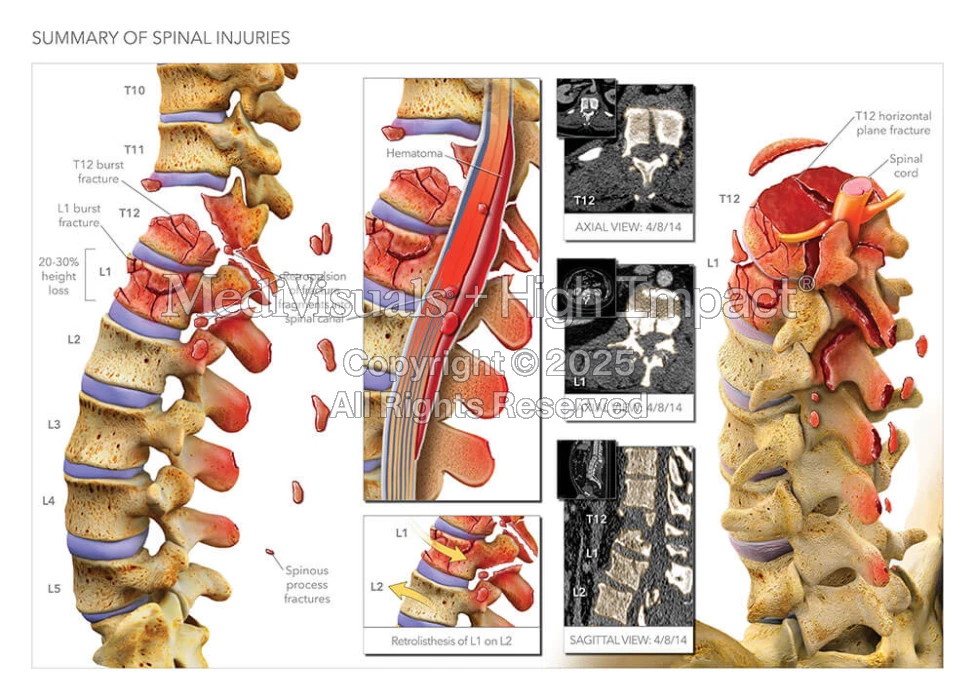Summary of Spinal Injuries | MediVisuals + High Impact