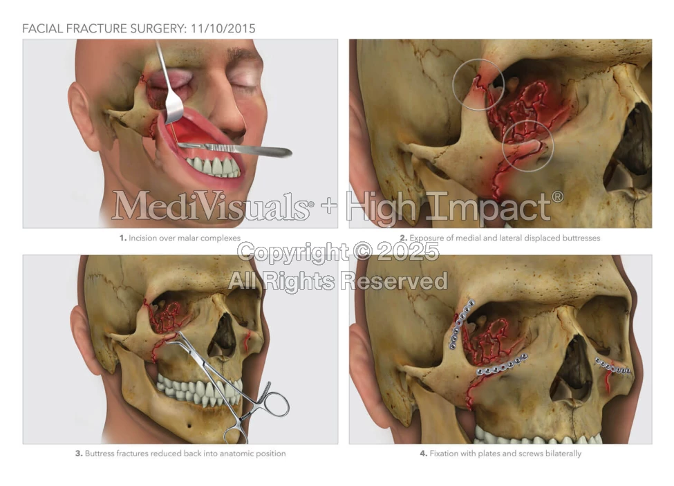 Facial Fracture Surgery | MediVisuals + High Impact