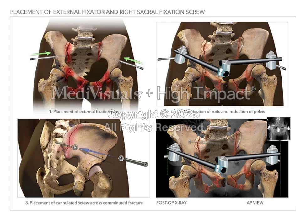 Placement of External Fixator and Right Sacral Fixation Screw ...