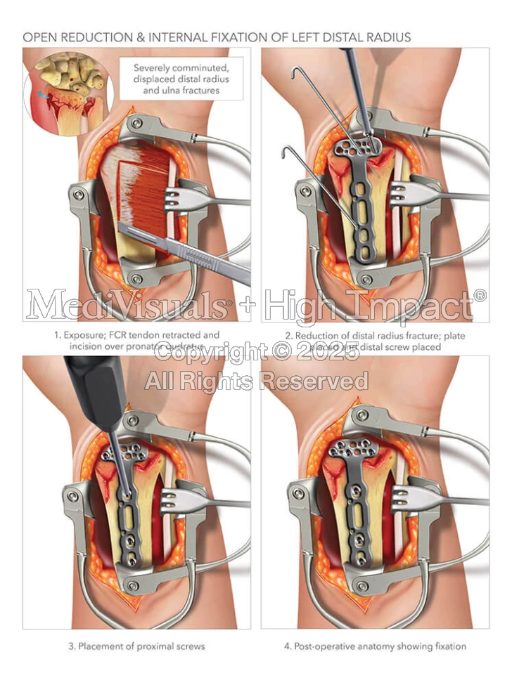 Open Reduction and Internal Fixation of Left Distal Radius | MediVisuals + High Impact