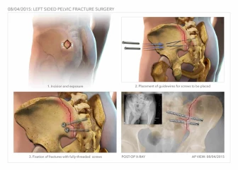 Pelvic Fixation