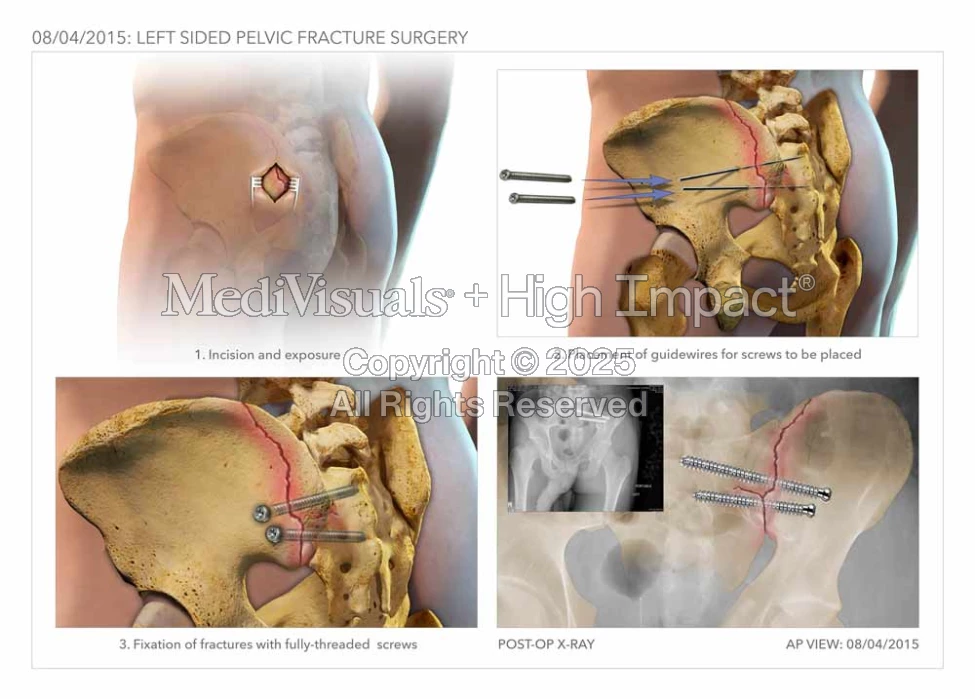 Pelvic Fracture Surgery | MediVisuals + High Impact