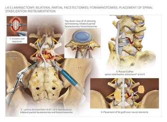 Medical Illustration - Spine Surgery