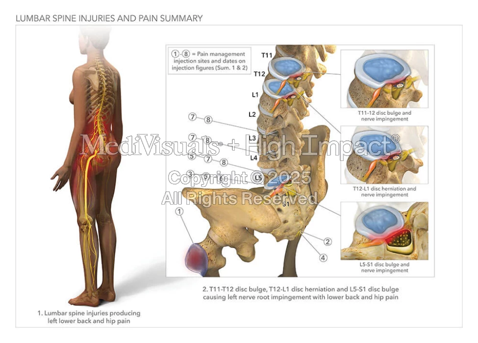 Lumbar Spine Injuries and Pain Summary | MediVisuals + High Impact
