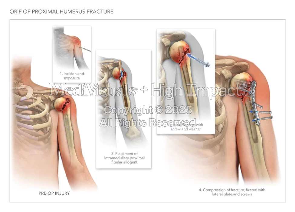 ORIF of Proximal Humerus Fracture | MediVisuals + High Impact