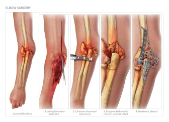 ORIF of Left Elbow | MediVisuals + High Impact